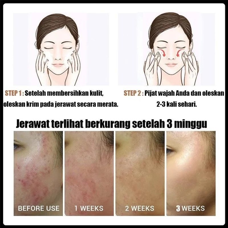 Acne Cream 20g Quick Acne Treatment Pimple Cream No Harm To Skin Acne ...