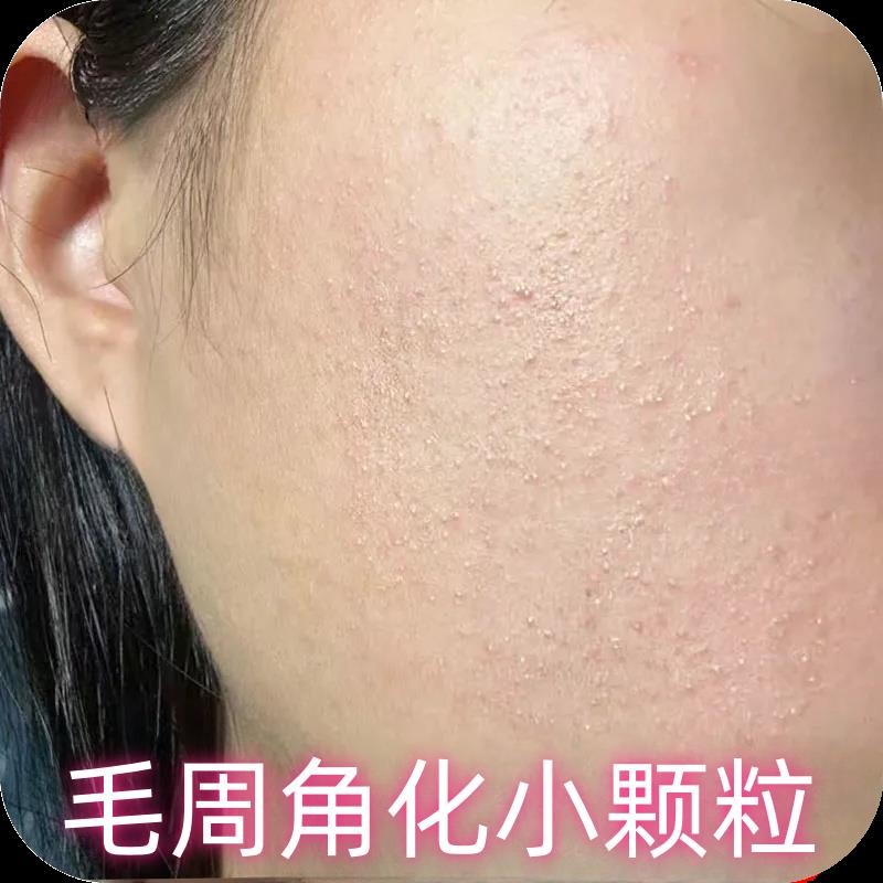 Rough Small Particles on Both Sides of Cheeks Have Black Spots Small ...