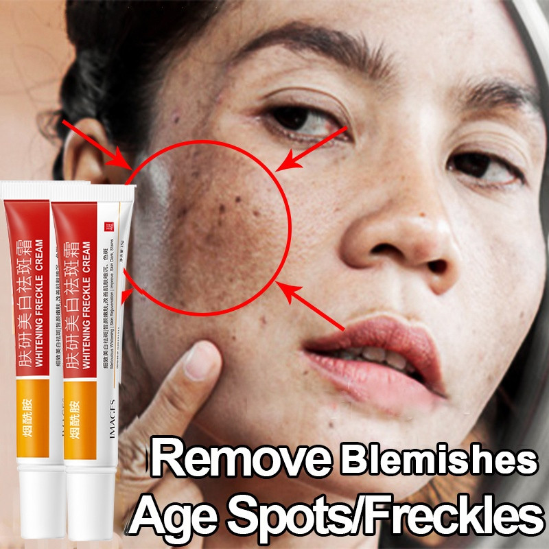 Freckle Melasma Cream Freckle Pigmentation Removal Cream and Dark Spot ...
