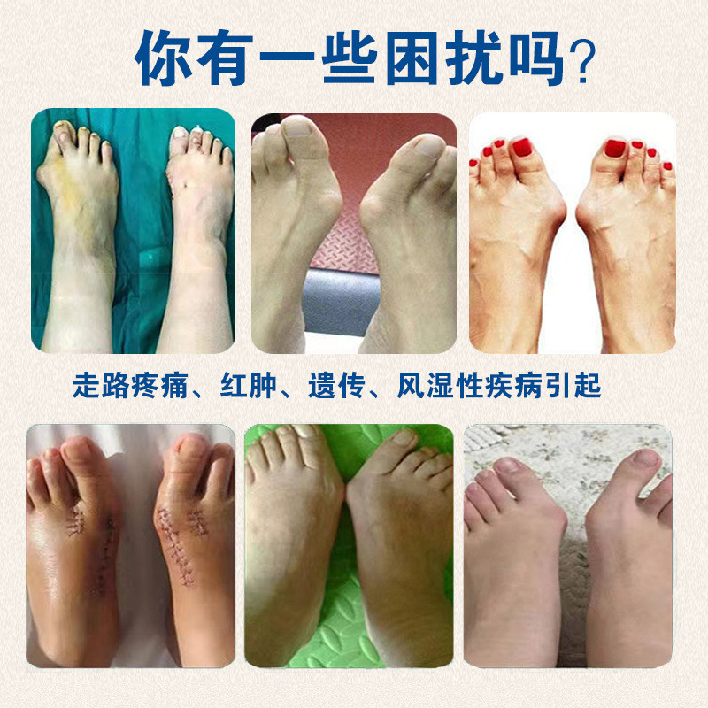 Home Practical!Thumb Valgus Corrector Big Foot Bone Dedicated Sticker ...