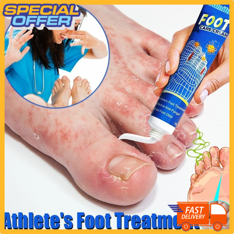 ubat kaki berbau Kaki mengelupas Kulat air Kaki gatal berbau Foot ...