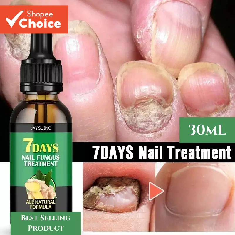 7 Days Ginger Nail Fungus Essence Onychomycosis Essence Toe Fungus Hand ...