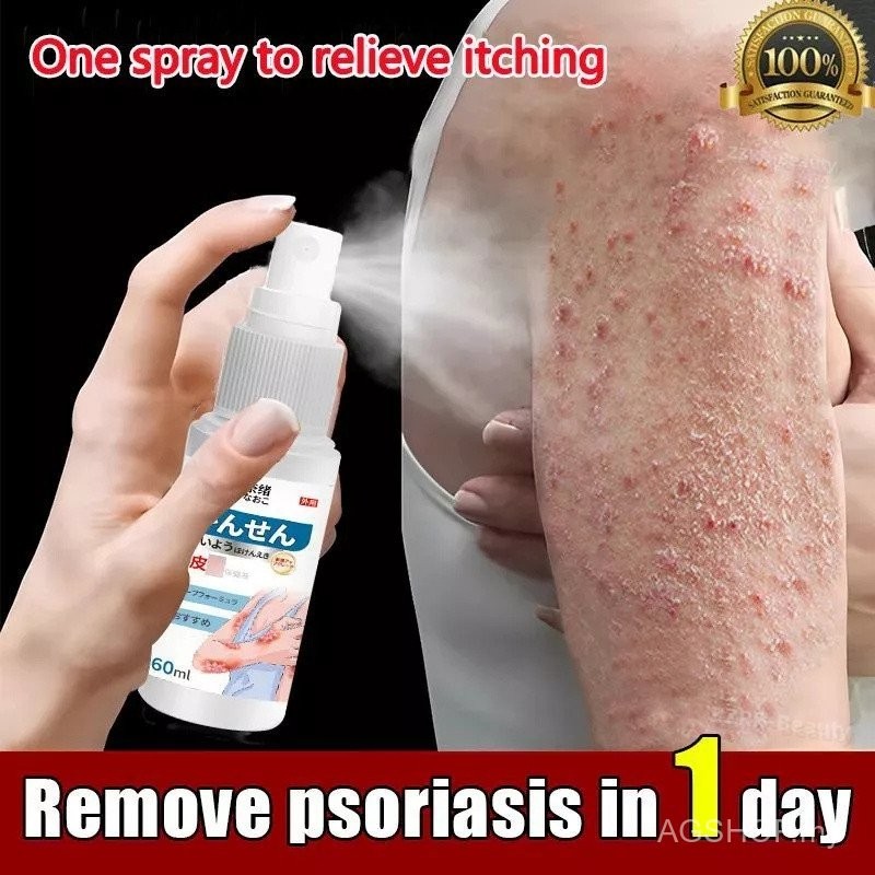 Psoriasis Spray Anti-Itch Eczema Relief Herbal Antifungal Skin Itch ...