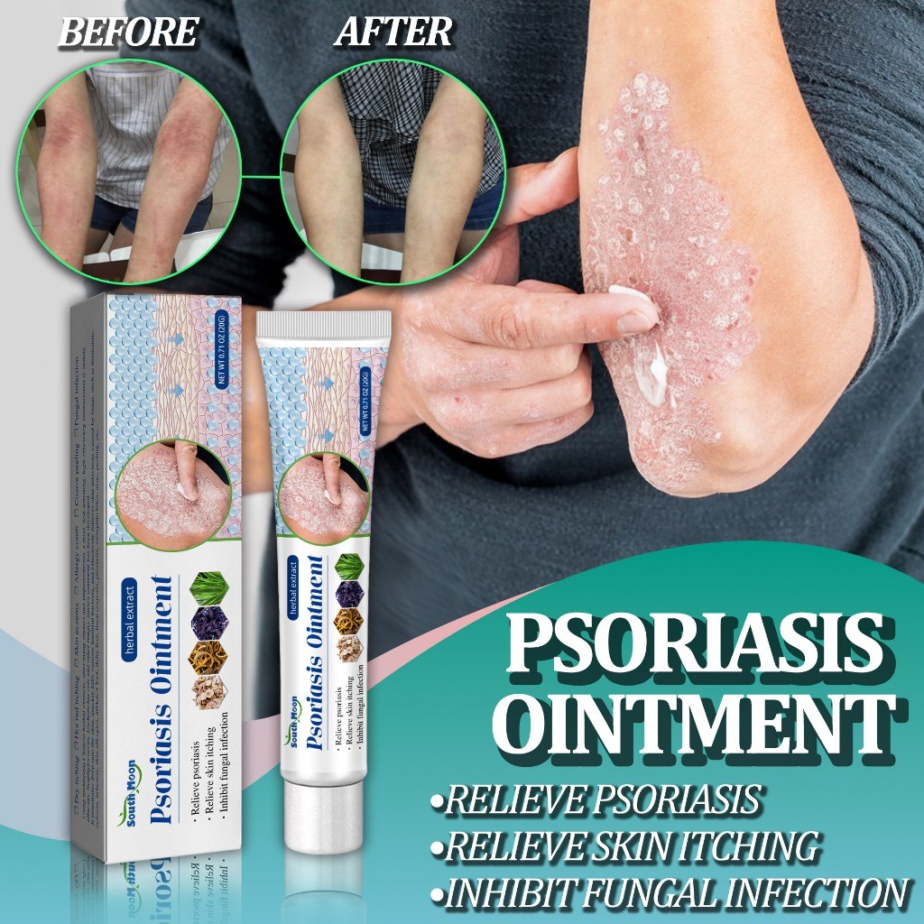 South Moon Psoriasis Special Ointment Scalp Ringworm Water Flea Body ...