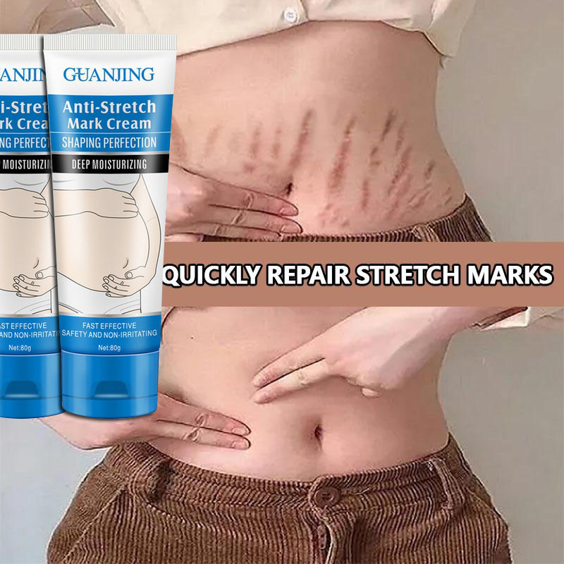 Anti-Stretch Mark Cream Intensive Skin Treatment for Improvement and ...