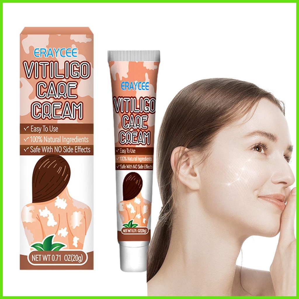 Cream for Vitiligo Skin 20g Vitiligo Repigmentation Relief & Removal ...