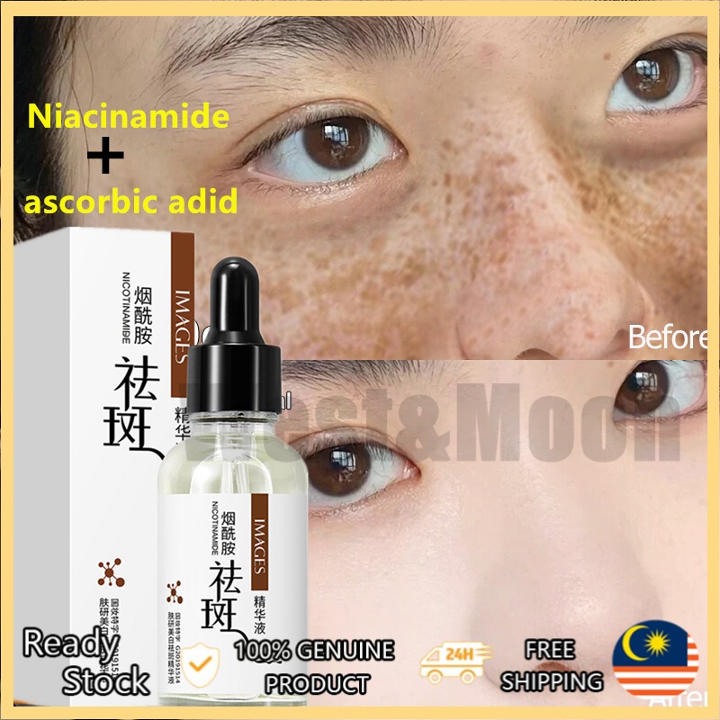 Ready Freckles Skincare Anti Freckles Serum 30ml Moisturizer Facial ...