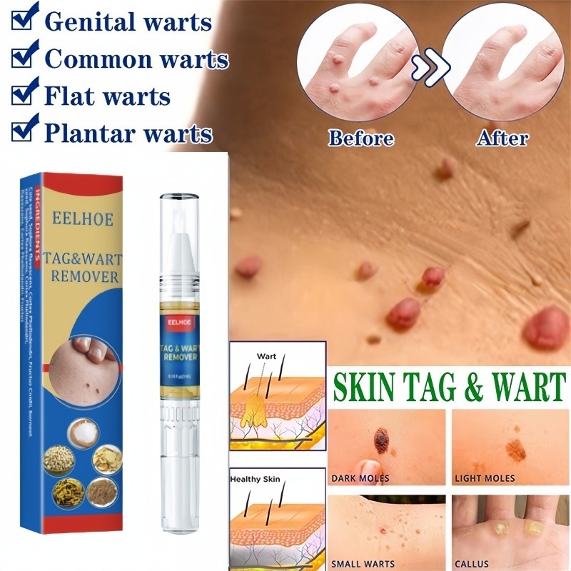 Ubat ketuat Tahi lalat remover Skin tag remover Buang tahi lalat dan ...