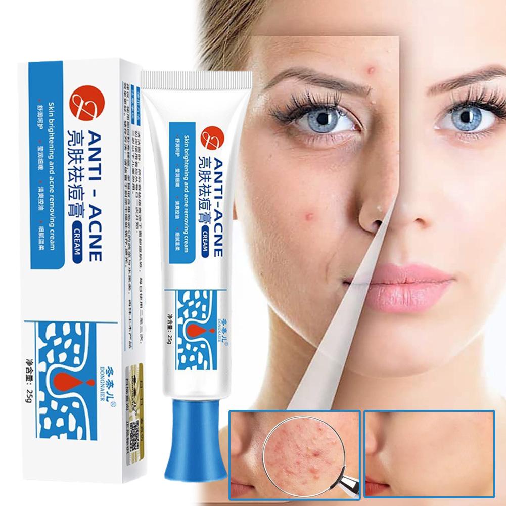 Brightening Acne Cream Facial Repair Dilute Acne Marks Pimples Care ...