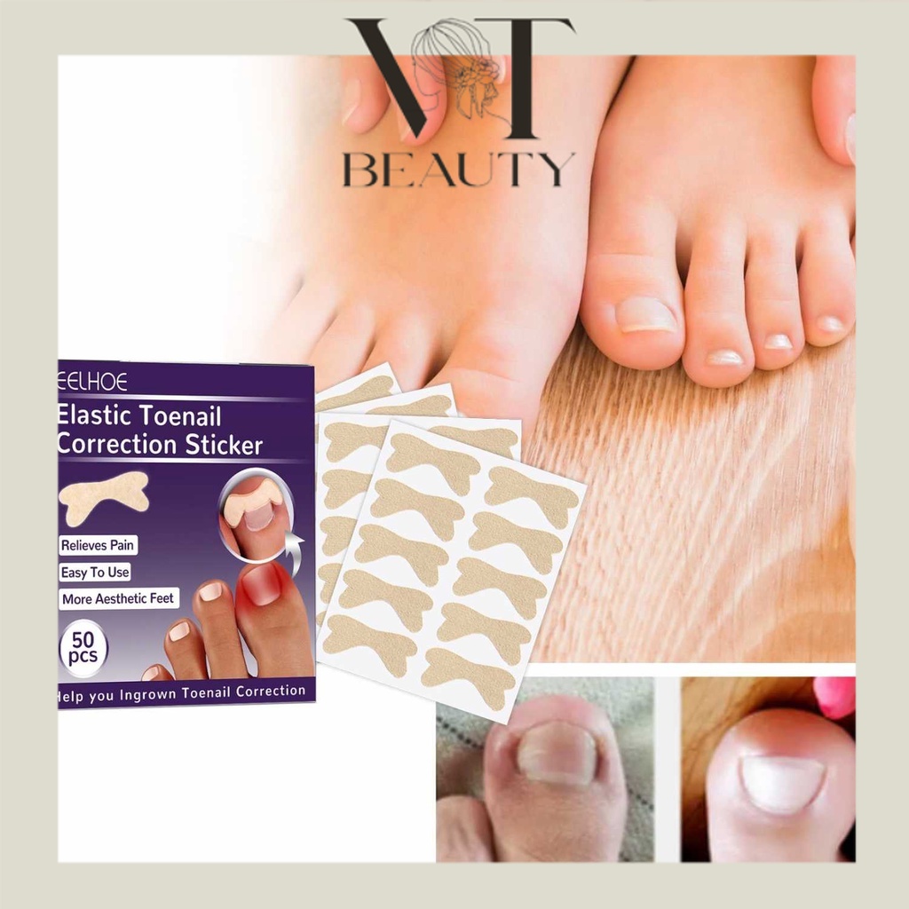 Adhesive Ingrown Toenail Patch Corrector Sticker 50pcs | Shopee Malaysia