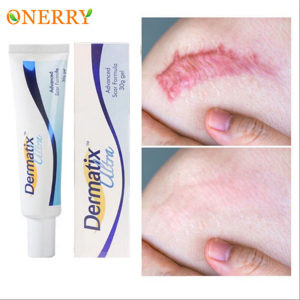 Dermatix Ultra Gel 15g Advance Scar Formula Removal Repair Skin Care ...