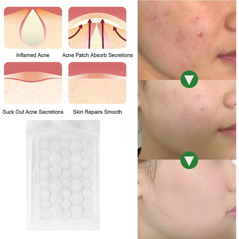 Acne Patch/ Hydrocolloid/Water Gel Invisible Concealer Patch Remove ...