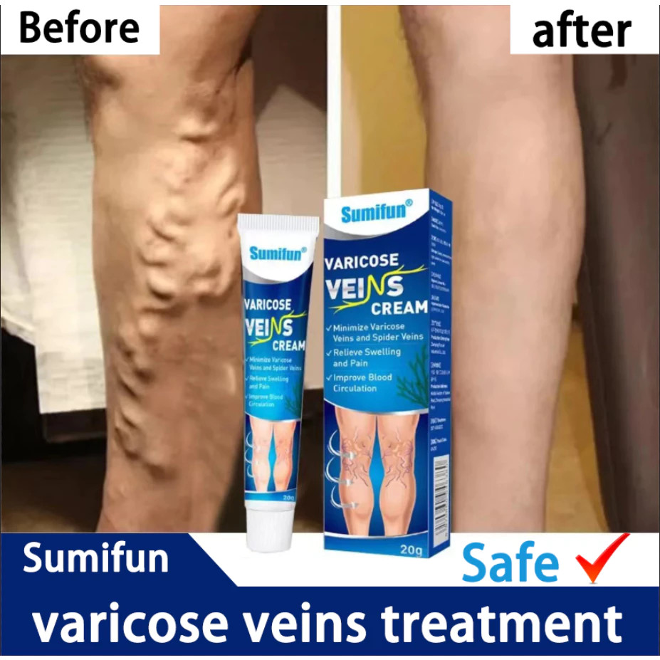 Gel Urat Urat Luaran Mampat Sejuk Bulge Bengkak Vena Kaki Cacing Tanah ...