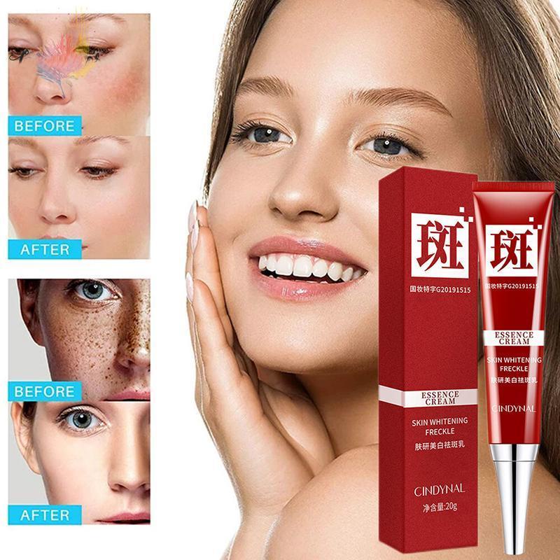 Original Strong Anti Freckle Whitening Cream Powerful Removing Age Dark Spots Pigmentation ...