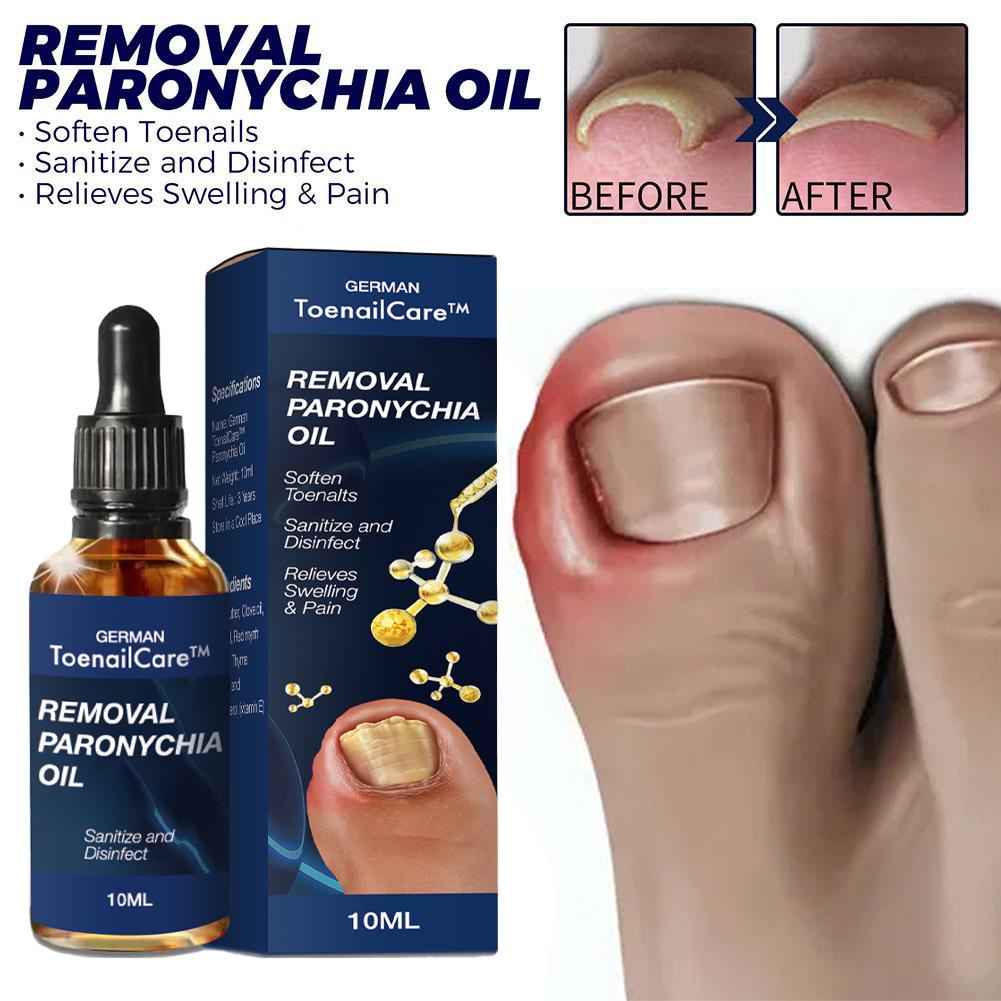 Anti Paronychia Relief Oil Ingrown Toenail Anti Fungal Toe Nail Ingrown ...