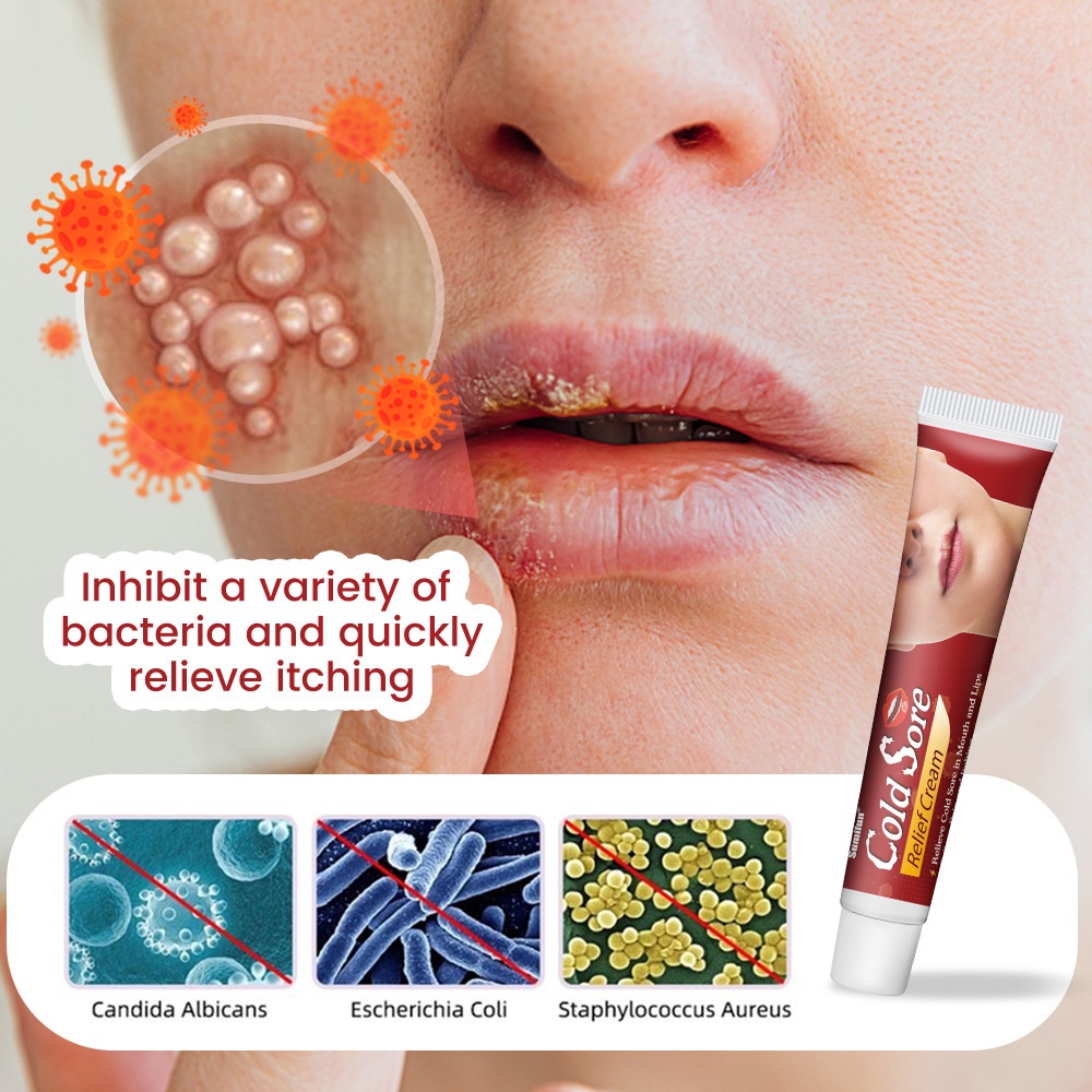 Cold Sores Lip Cheilitis Treatments Cream Herpes Antibacterials ...