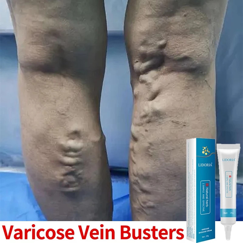 Otot Hijau Vaskular Cacing Tanah Kaki Benjolan Produk Tulen ...