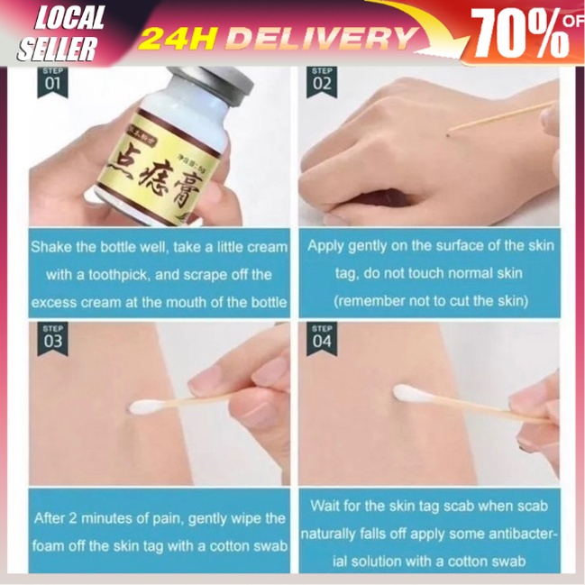 ubat kutil tahi lalat ketuat dan biji kolesterol skin tag Warts Removal ...