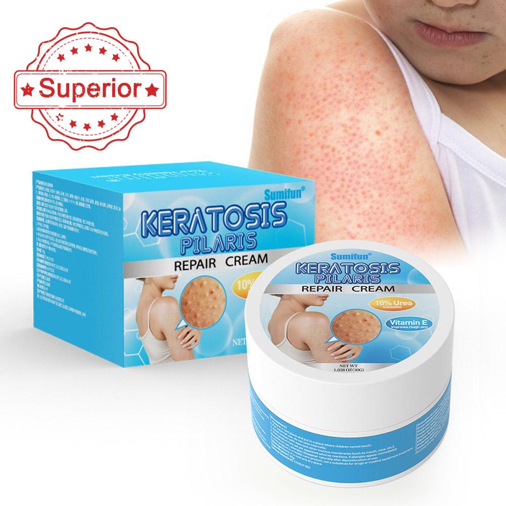 Sumifun Vitamin E Chicken Skin Cream Peel Removing Cream C4C4 | Shopee ...