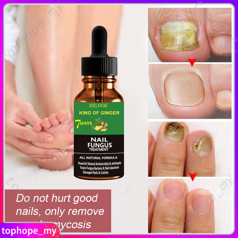 Eelhoe 7 Days King Of Ginger Nail Fungus Essence Repair Onychomycosis