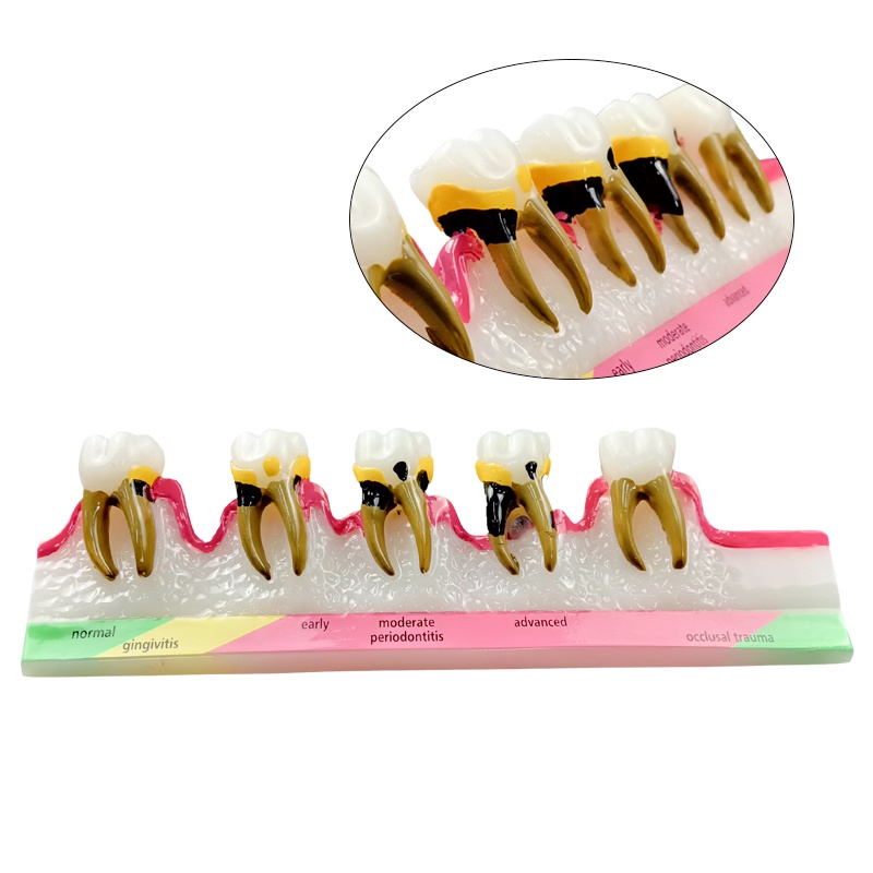 Dental Model Caries Classify Pathological Model Tooth Caries Evolution ...