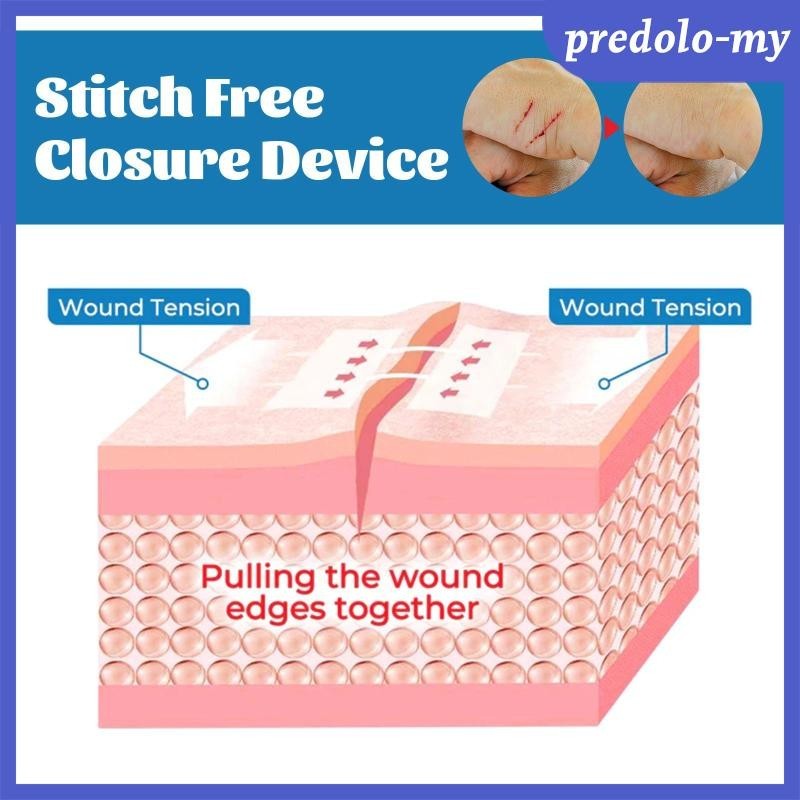 [PredoloMY] Emergency Wound Closures Zipper without Stitches Painless ...