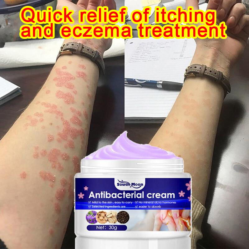 100% Effective Herbal Psoriasis Dermatitis Eczema Pruritu Psoriasis ...