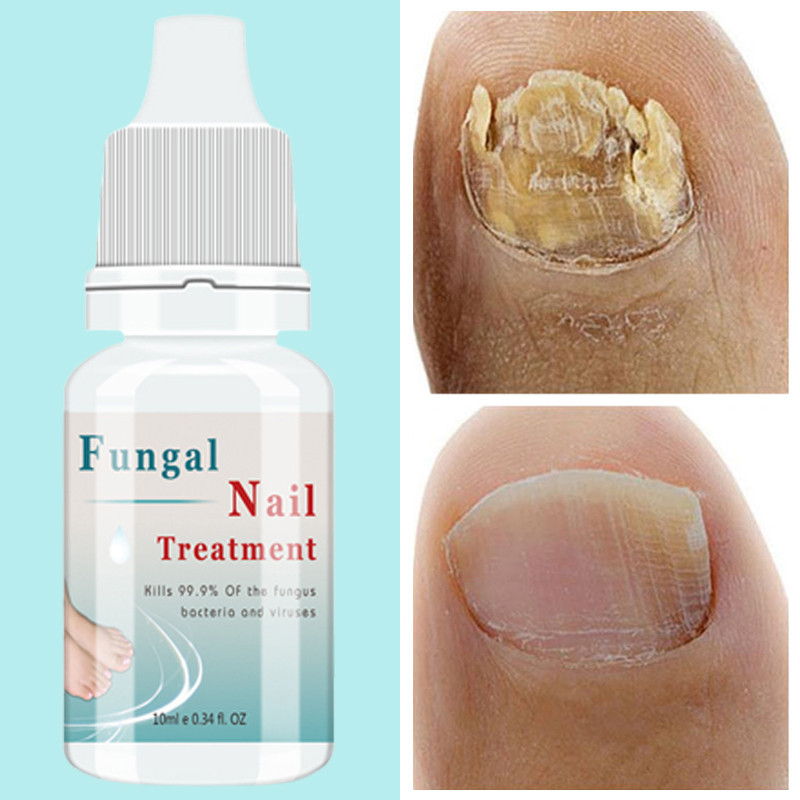 Nail Fungus Treatment Serum Foot Repair Liquid Toe Nails Fungal Removal ...