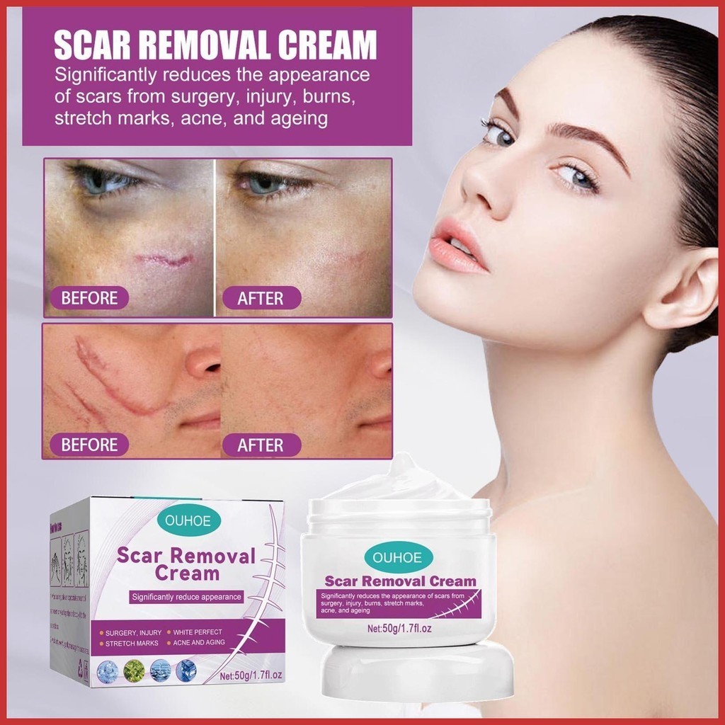 Scar Removal Cream Stretch Mark Cream Scar Balm for Stretch Mark ...
