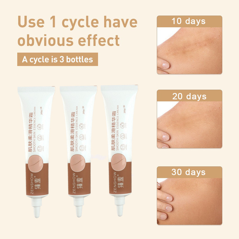 ZHENXIU Skin Smooth Repair Cream(肌肤平滑修护霜)20g Lightens Scar Marks ...