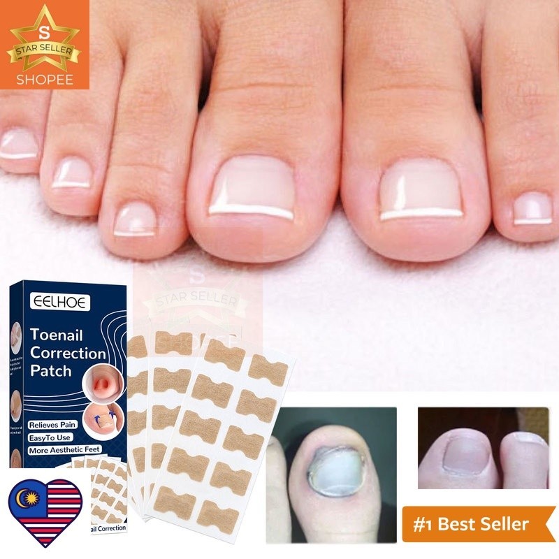 (MW)50Pcs Nail Art Ingrown Correction Sticker Toenail Elastic Patch ...