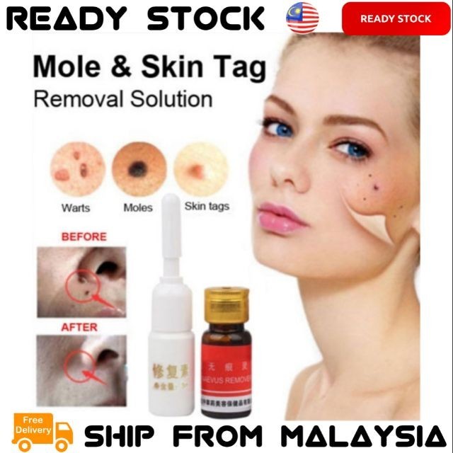 Skin Mole Remover Set Face Care Tags Warts Removal Repair Solution Kit ...