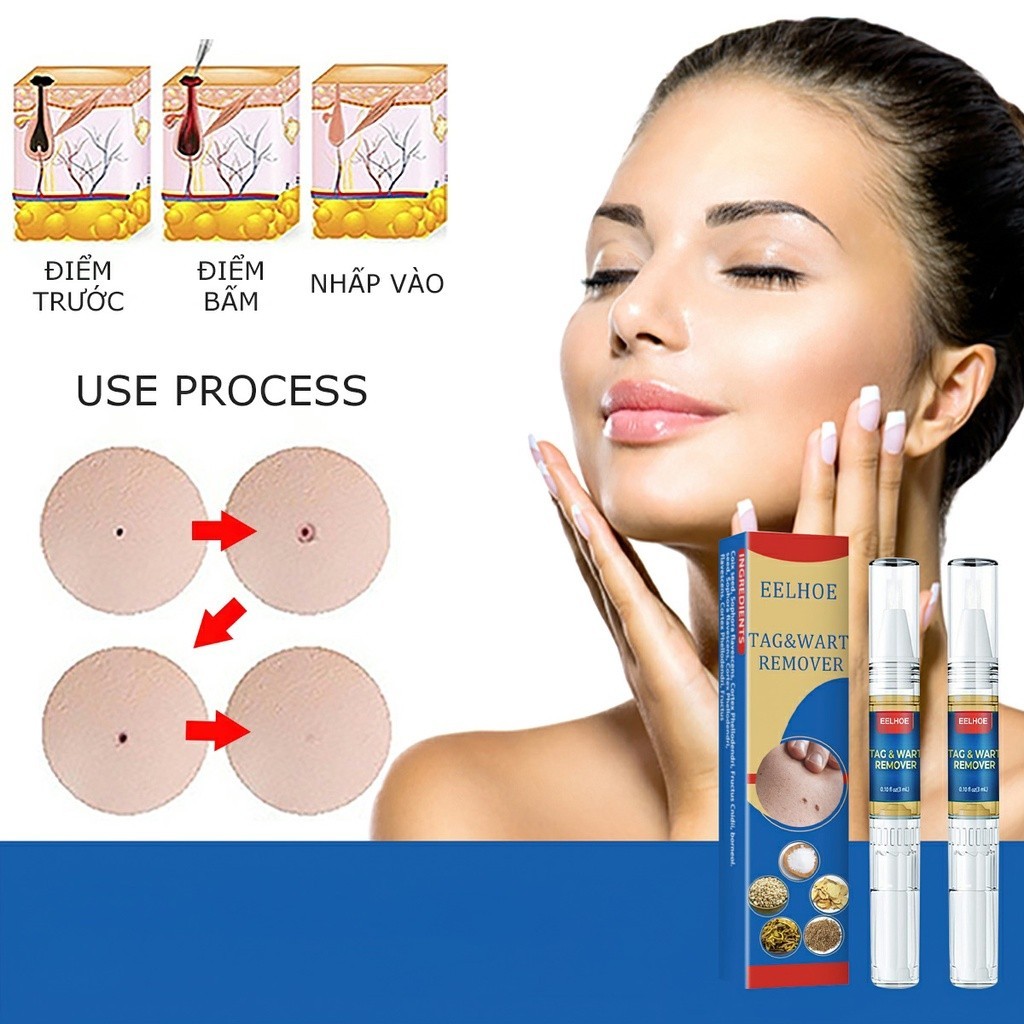 Mole removal removes moles on the face, freckles, warts, skin tags ...