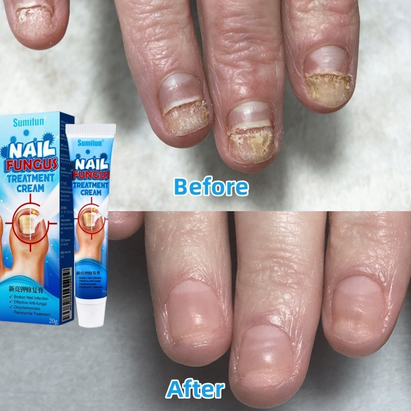Nail fungus Nail Repair treatment cream Ubat kuku kaki dan tangan kulat ...