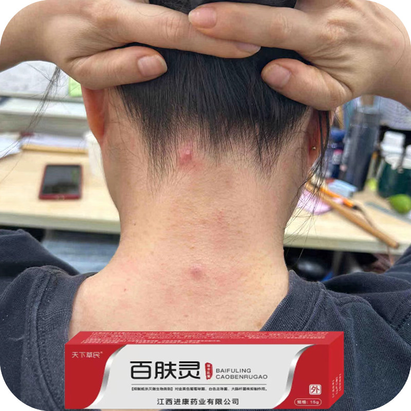 Neck Acne Red Pimples Hill Rash Whitening Point Pain Red Swollen Front ...