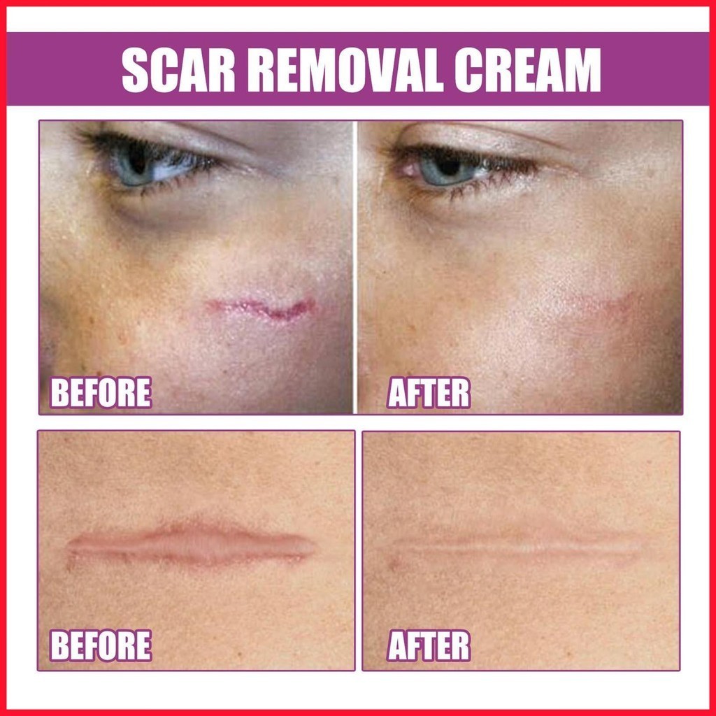 Surgical Scar Removal Cream Burn Repair Balm for Face and Body Scar ...