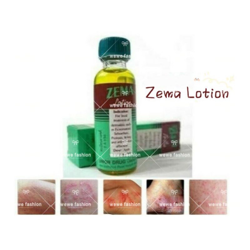 READY STOCK!!!ZEMA lotion 15ml cream 5cc Untuk Kulit Gatal Dermatitis ...