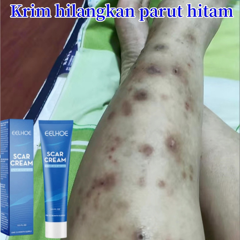 Krim hilangkan parut hitam Hilangkan parut kaki Hilangkan parut kudis ...