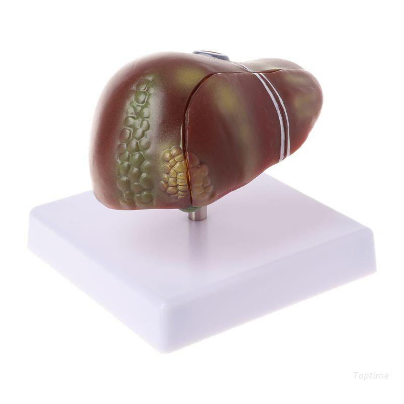 Top Human Liver Pathological Anatomical Model Anatomy School Medical ...
