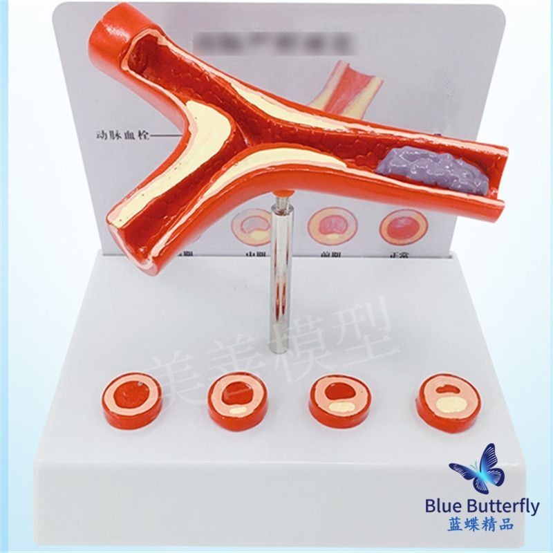 Blockage Vascular Blood Concentration Fat Pathology Blood Vascular ...