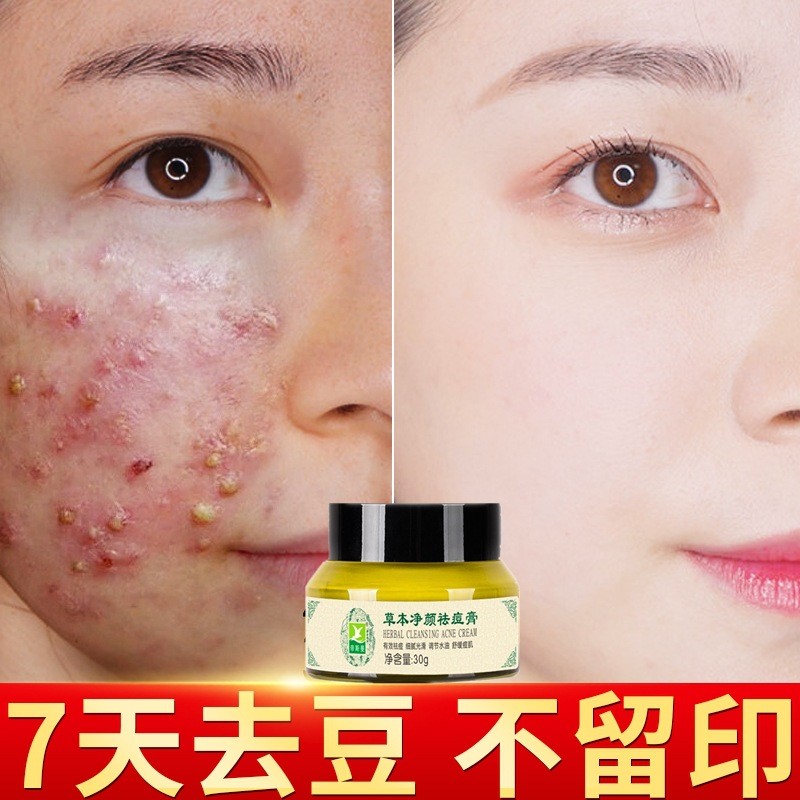 Acne Removal Mark Fade Cream Closed Acne Repair Acne Pit Cleansing Acne ...