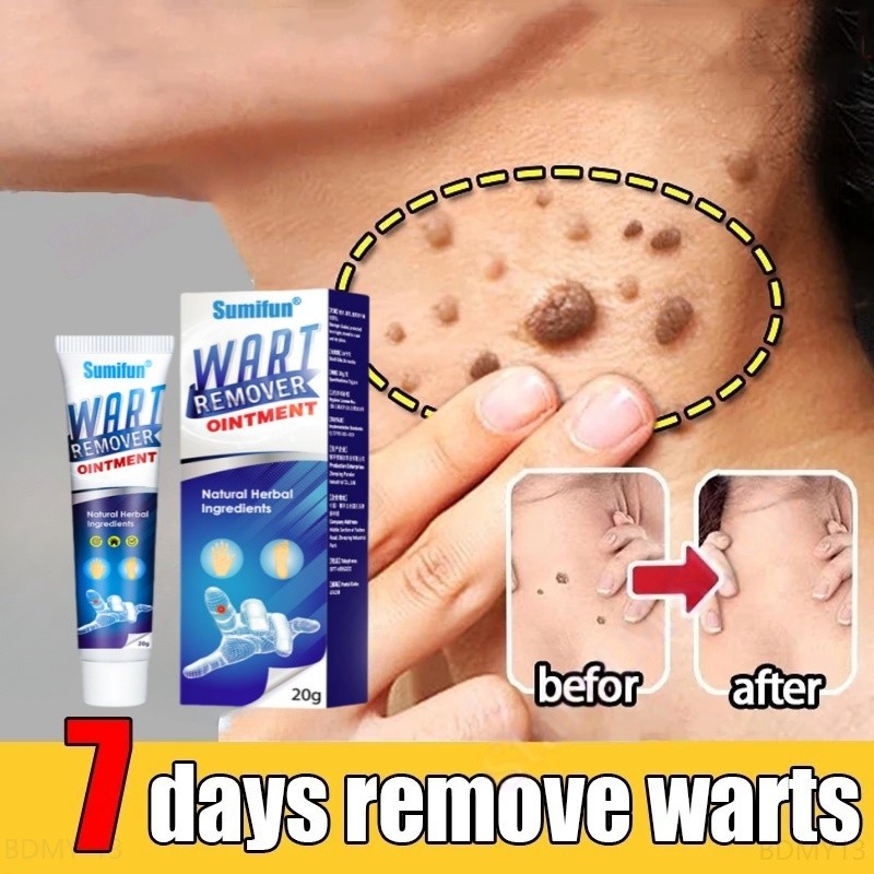 Hot Wart Removal Cream Ubat Kutil Removal Tahi Lalat Remover Warts ...