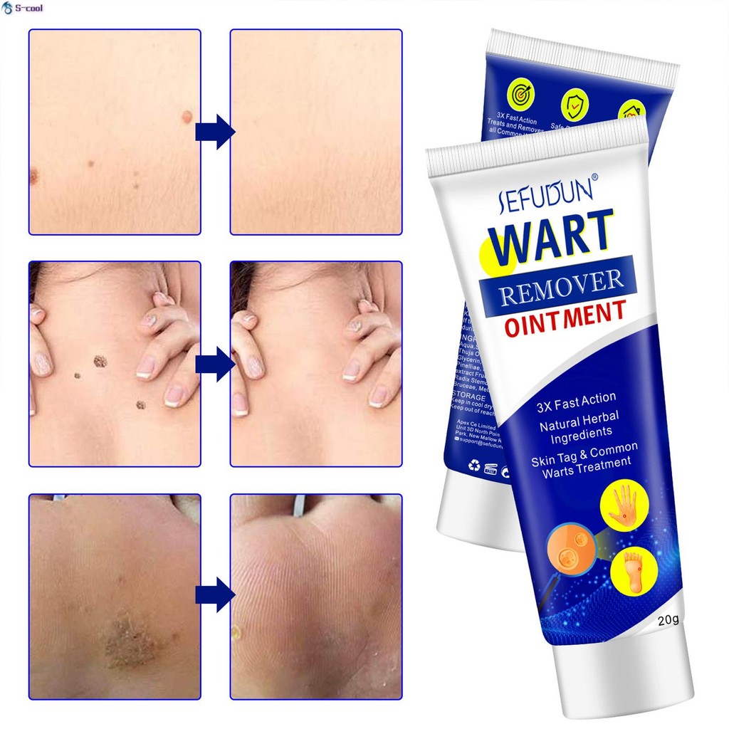 Moles Skin Fade Cream Strength Fighting Skin Tags Remover Cream for ...