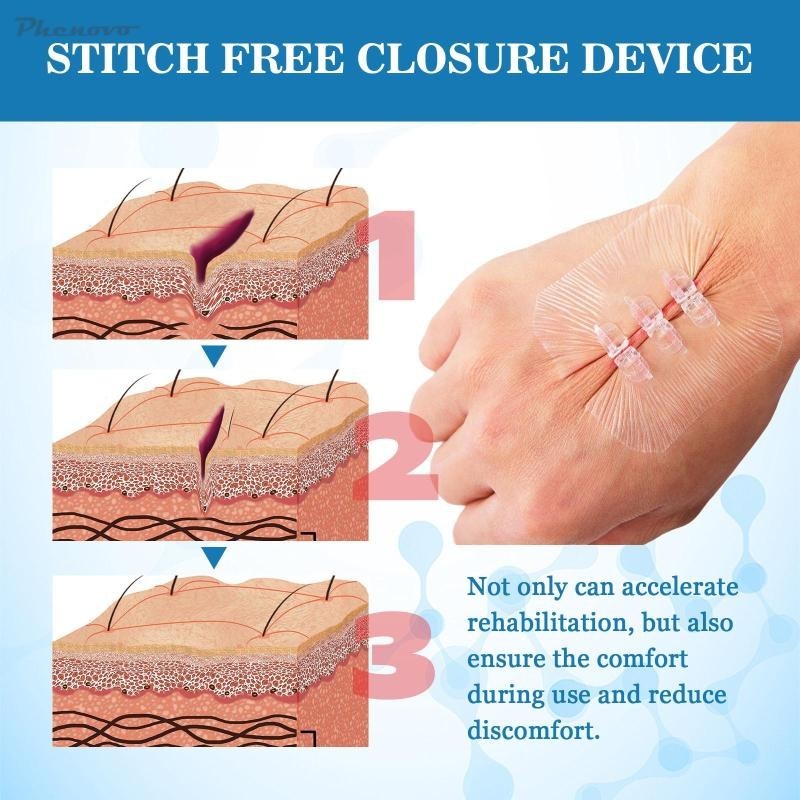 [Colaxi1ddMY] Emergency Wound Closures Zipper without Stitches Painless ...