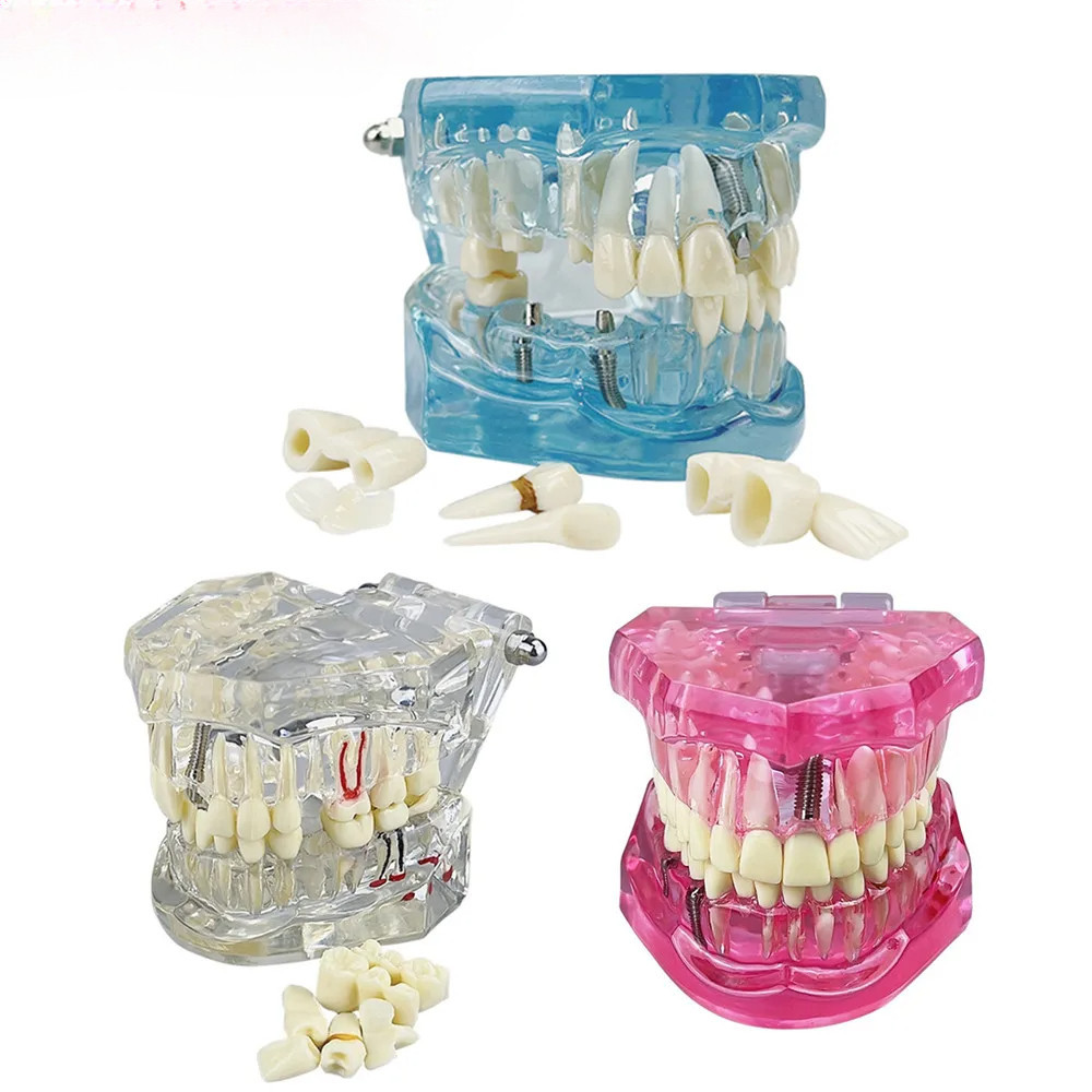 Standard Dental Teeth Model Implant Disease Dentist Studying Demo ...