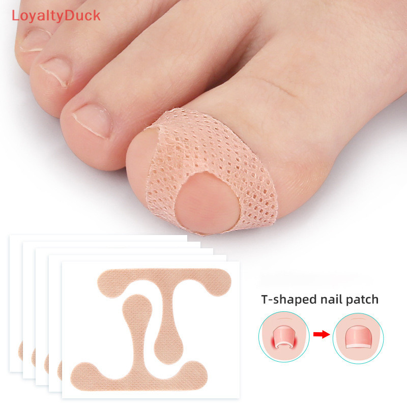 [LoyaltyDuck] 2Pcs T-shaped Toenail Correction Stickers Ingrown Toenail ...