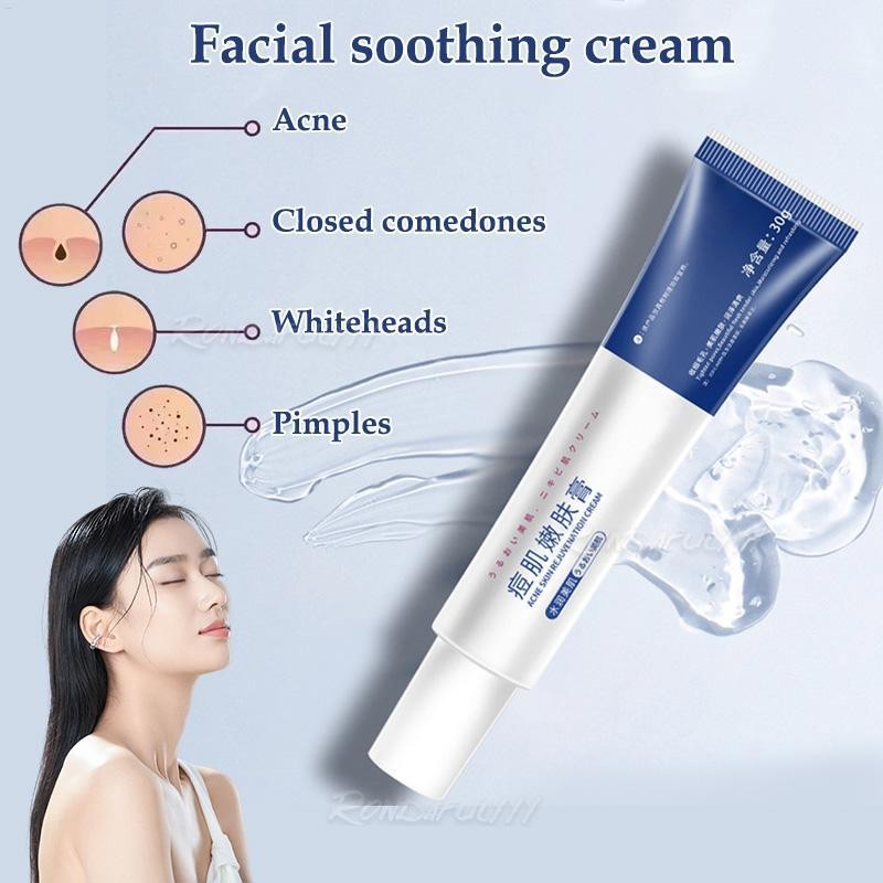 Pimple Ointment for Face Soothing Anti Pimple Care Cream Even ...