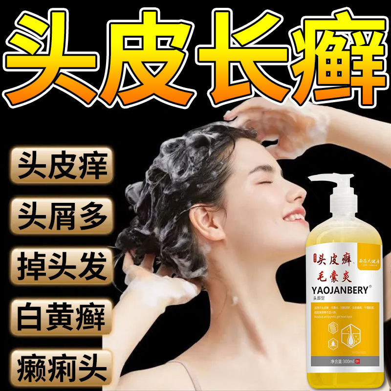 Scalp Ringworm Shampoo Medical Scalp Scab Itchy Scalp Pim Scalp