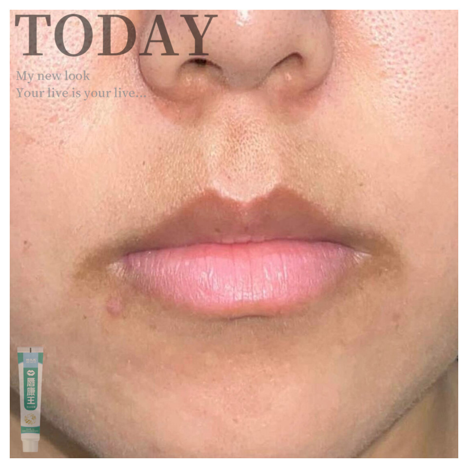 [Around Lip Melanin] Remove Lips Dark Corners Dull Moisturizing ...