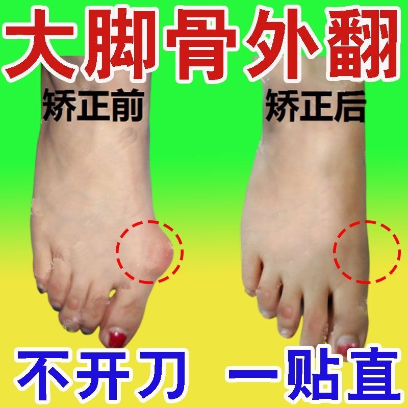 Hallux Valgus Patch Perfect Correction Of Hallux Valgus Corrector Big Foot Bone Deformation Toe